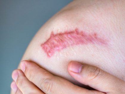 Skar Hipertrofi dan Keloid Adalah Bekas Luka yang Timbul. Apa Bedanya ...