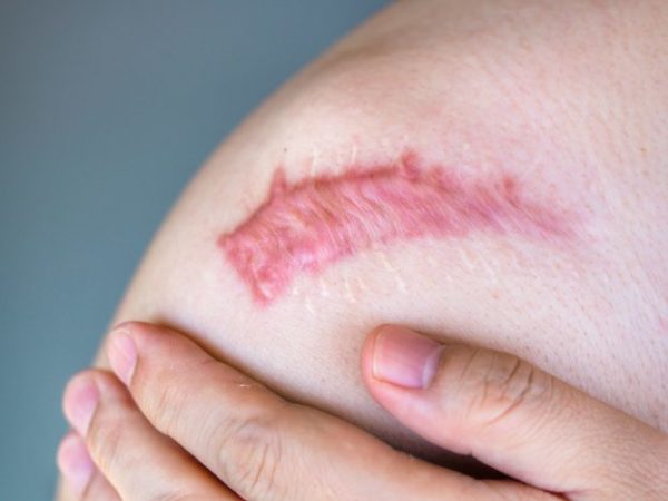 Skar Hipertrofi dan Keloid Adalah Bekas Luka yang Timbul. Apa Bedanya ...